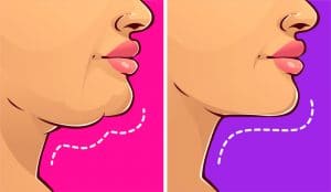 How to Get Rid of Double Chin: Ways to Lose Chin Fat