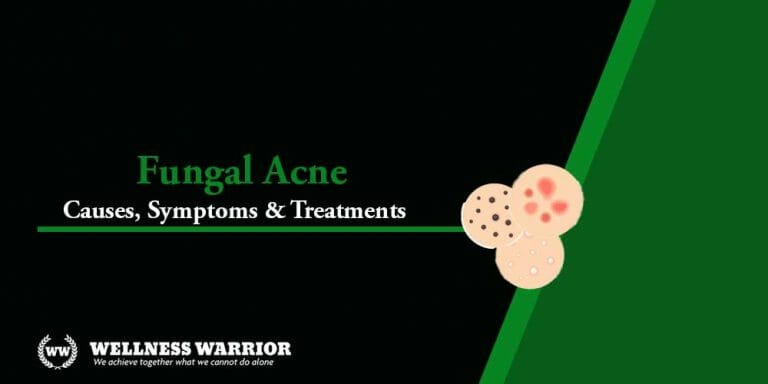 Fungal Acne: Is it a Real Thing? + (Symptoms and Treatments)