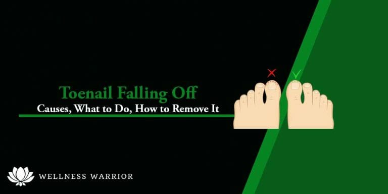 Toenail Falling Off: Causes, What to Do, How to Remove It