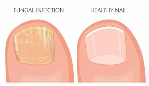 Toenail Falling Off: Causes, What to Do, How to Remove It