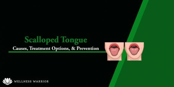 Scalloped Tongue: Causes, Treatment Options, & Prevention