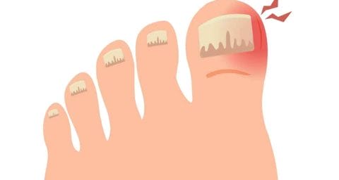 Identifying Progress: Signs Your Toenail Fungus is on Its Way Out